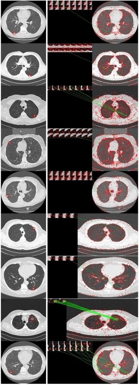 the detected and matched nodule features obtained using sift flann download scientific diagram