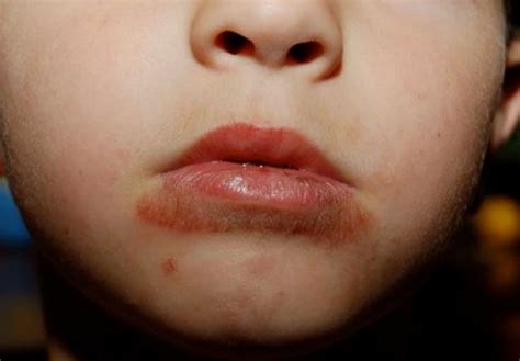 What Causes a Rash Around Your Mouth and How to Treat It Effectively ...