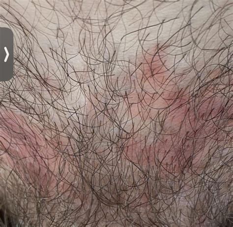 Red Lumps in Pubic Area: Causes and Treatment Options - Berkeley ...